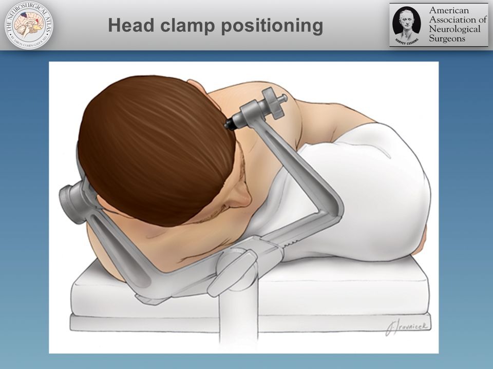 DECOMPRESSION MICRO-VASCULAIRE • Association Française des Céphalées